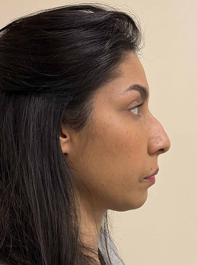 Hudson Facial Plastic Surgery - Chicago’s Premier Deep Plane Facelift