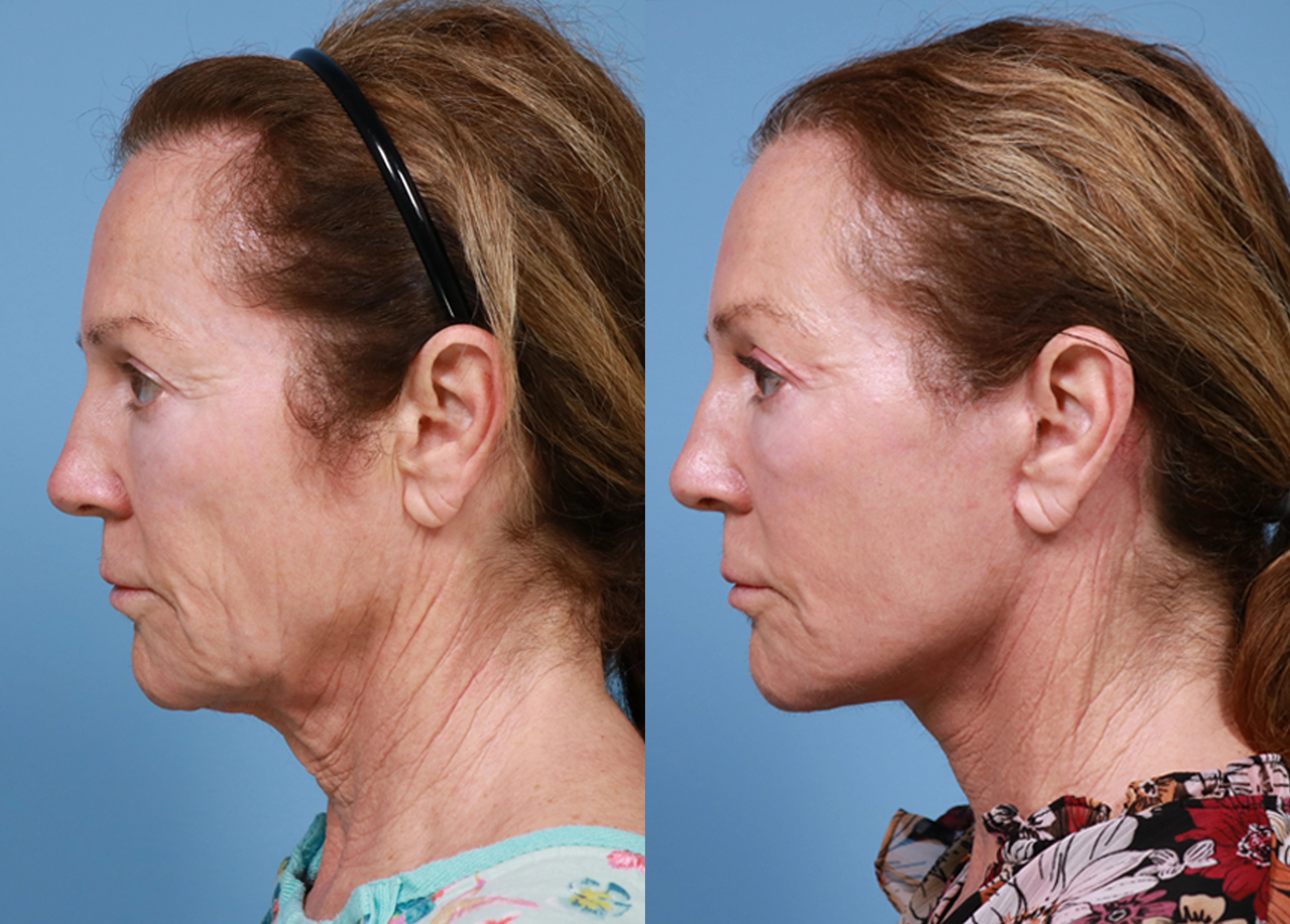 Deep Plane Facelift Chicago | Dr. Caroline Hudson